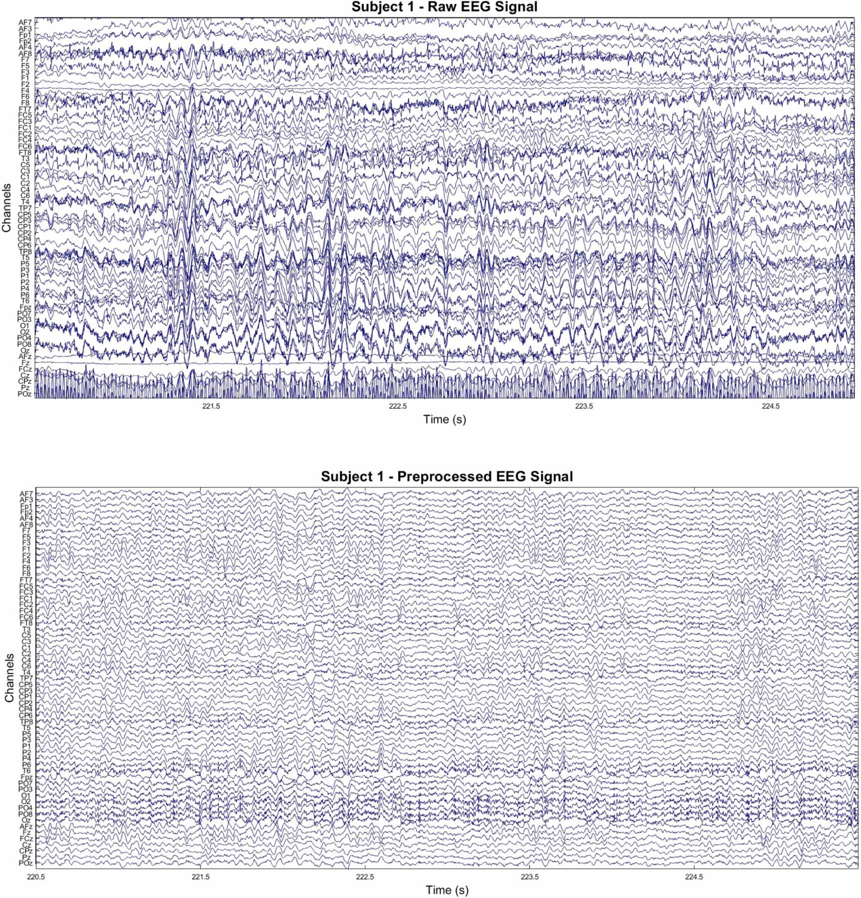 An attention-based deep learning approach for the classification of subjective cognitive decline ...