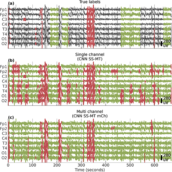 A multi-task and multi-channel convolutional neural network for semi-supervised neonatal ...