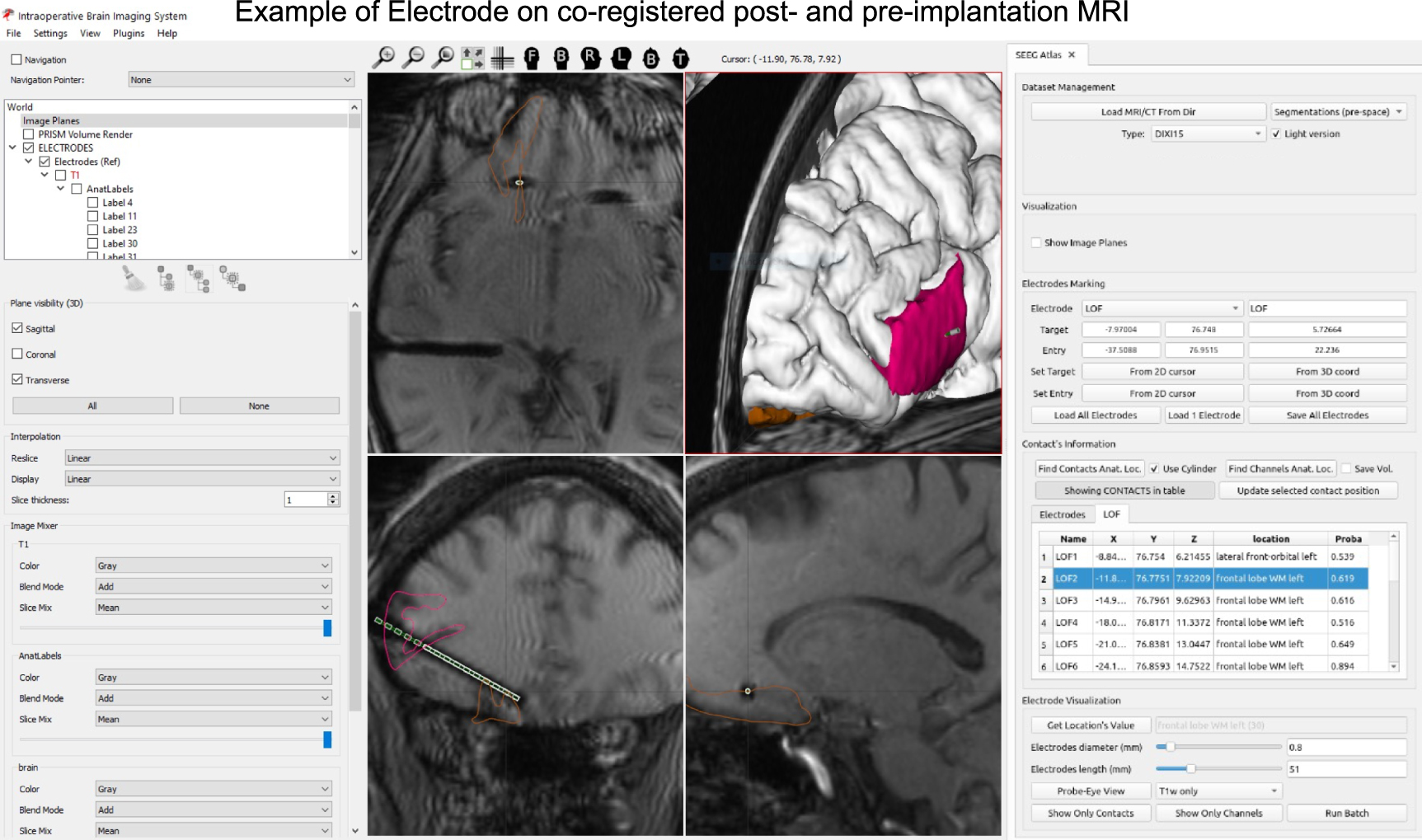 SEEGAtlas: A framework for the identification and classification of ...