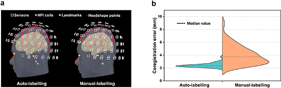 An artificial intelligence–based pipeline for automated detection and localisation of epileptic ...