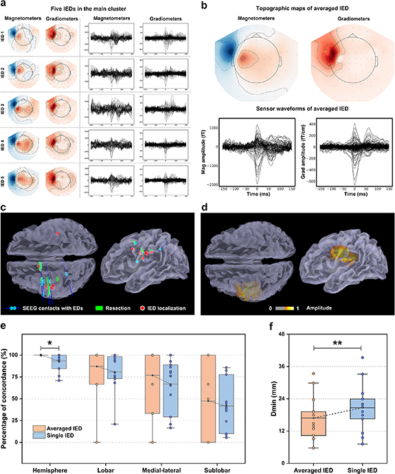 An artificial intelligence–based pipeline for automated detection and localisation of epileptic ...