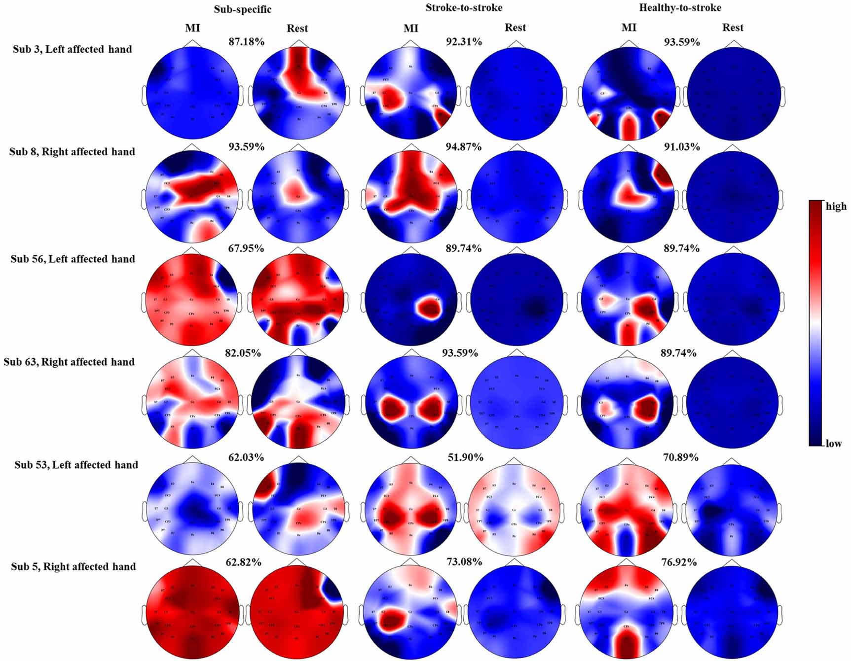 Transferring a deep learning model from healthy subjects to stroke ...
