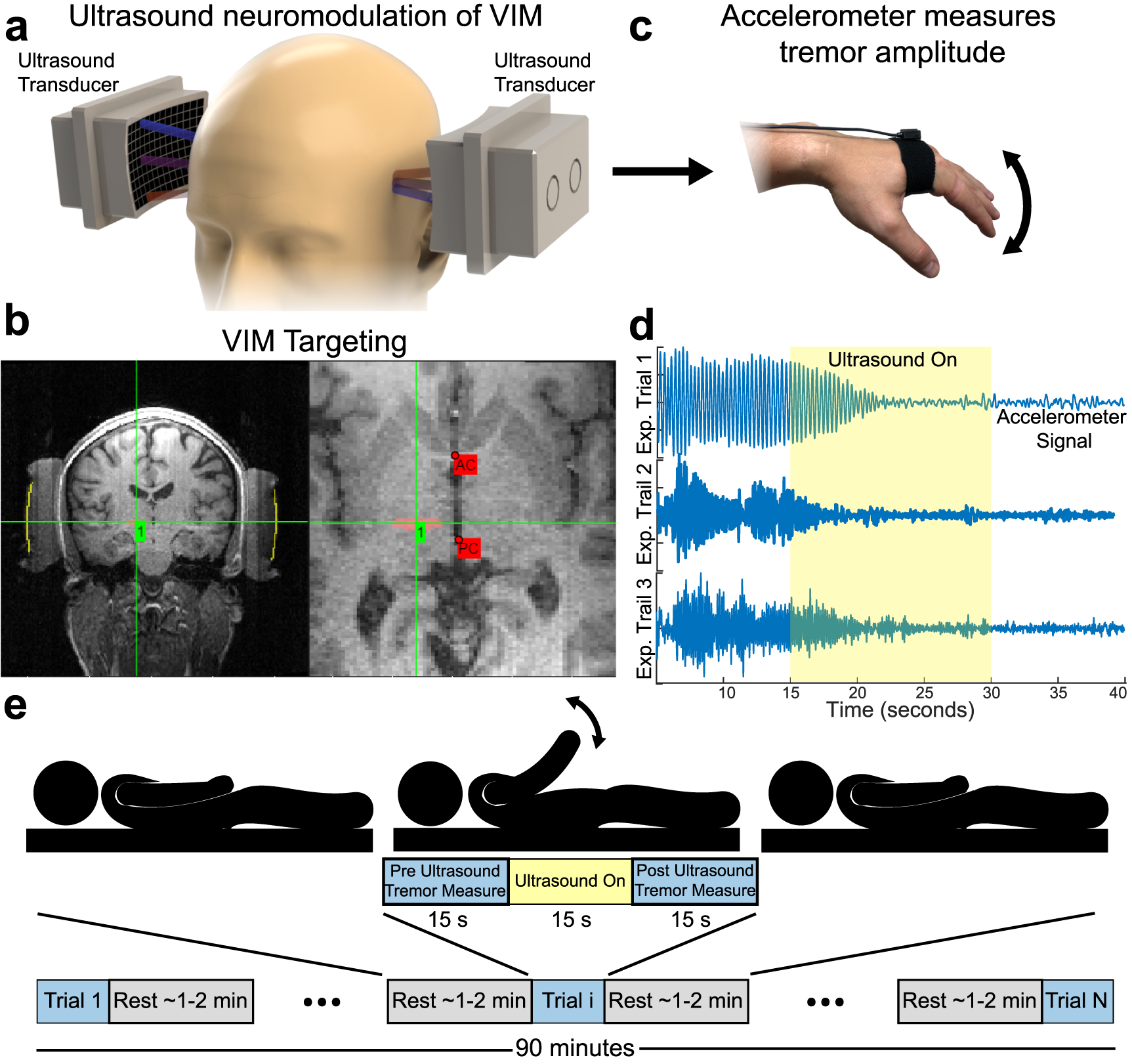 Noninvasive modulation of essential tremor with focused ultrasonic ...