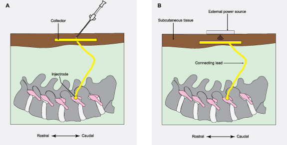 Computational modeling of dorsal root ganglion stimulation using an ...