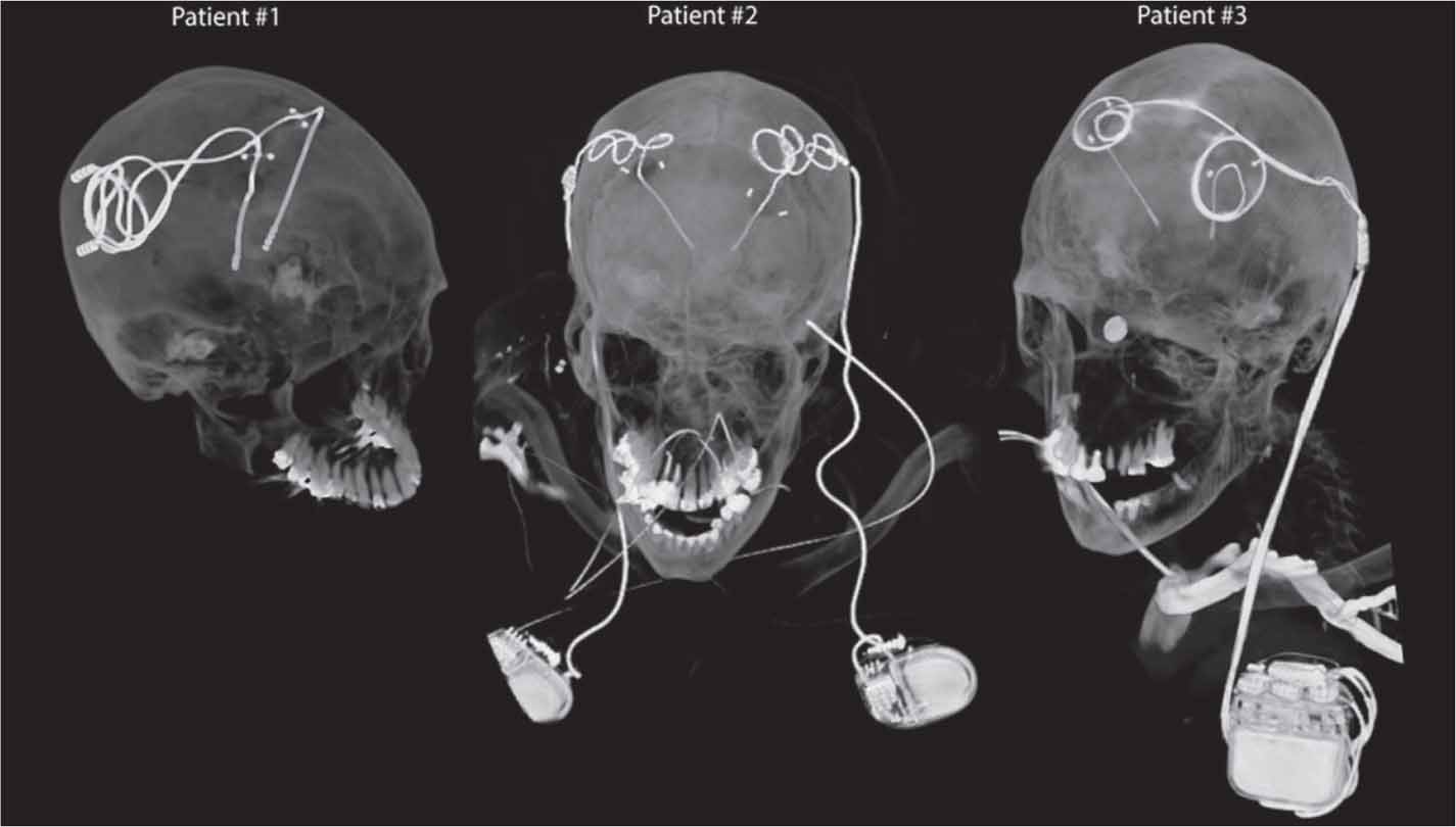 Safety of non-invasive brain stimulation in patients with implants: a ...