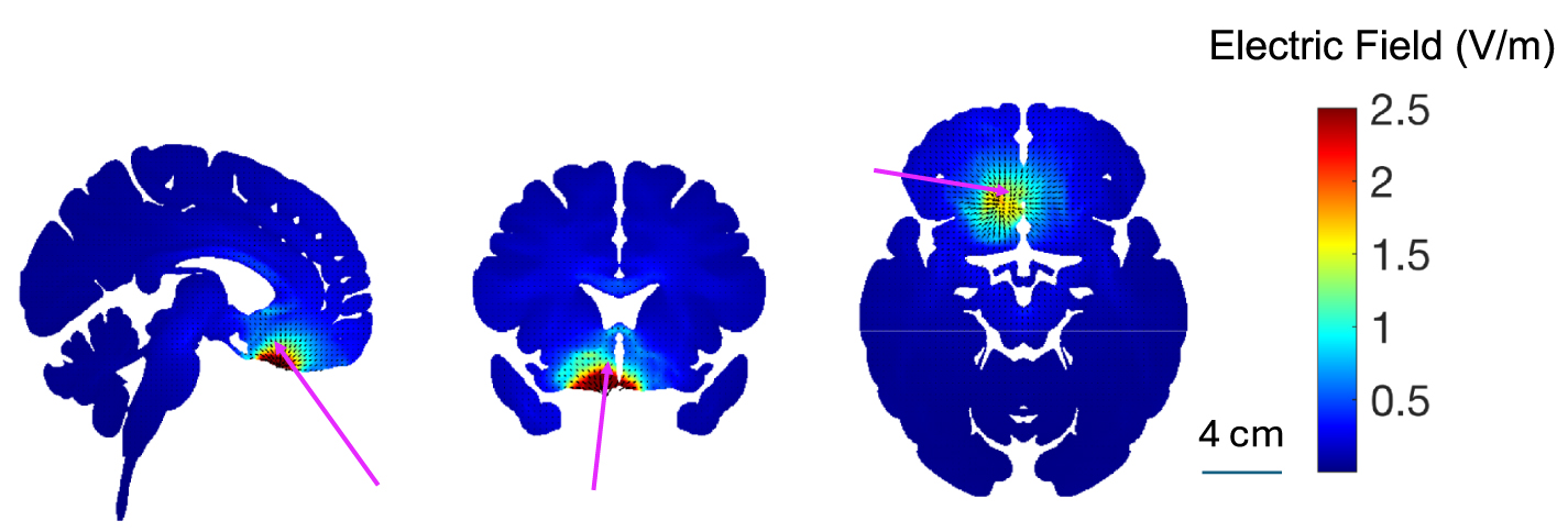 DeepFocus: a transnasal approach for optimized deep brain stimulation of reward circuit nodes ...