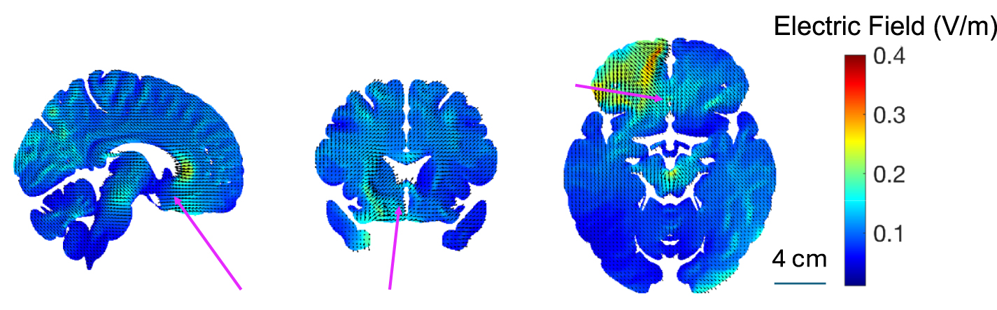 DeepFocus: a transnasal approach for optimized deep brain stimulation of reward circuit nodes ...