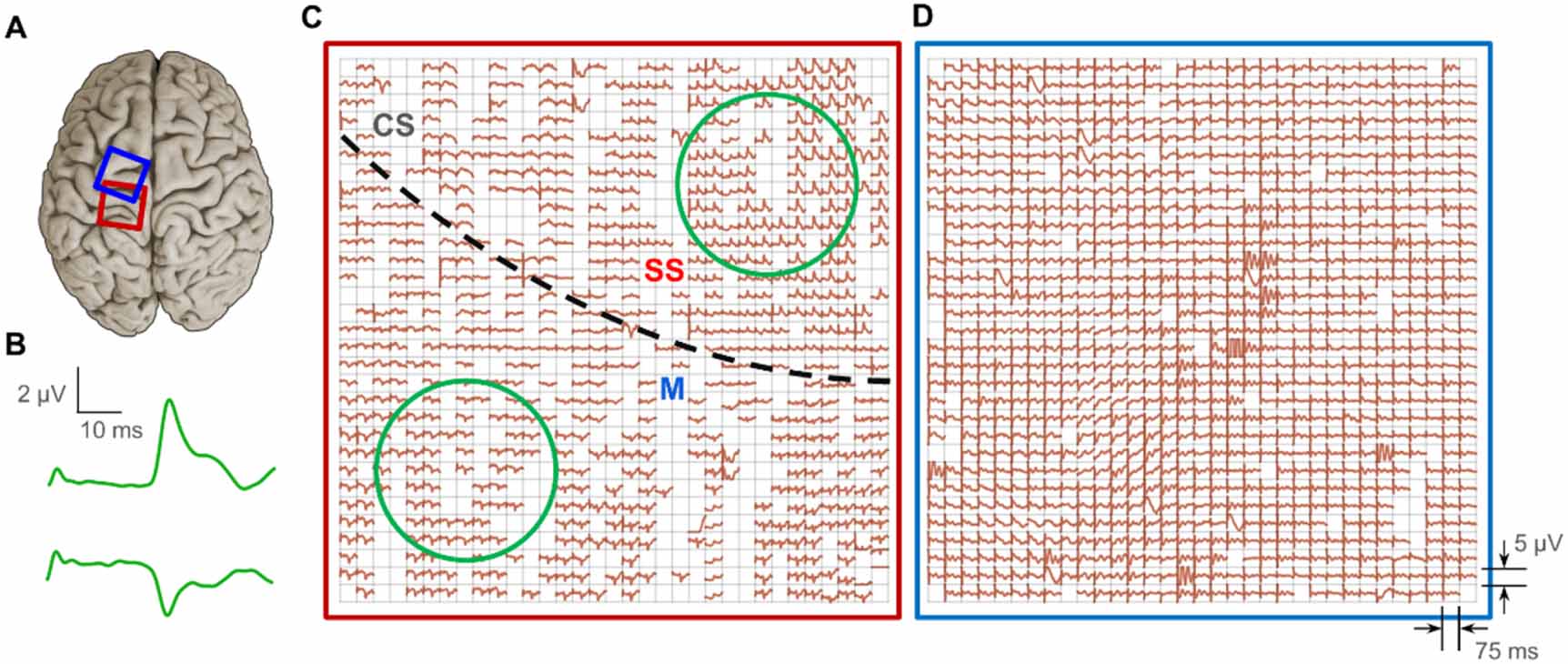 First-in-human experience performing high-resolution cortical mapping ...