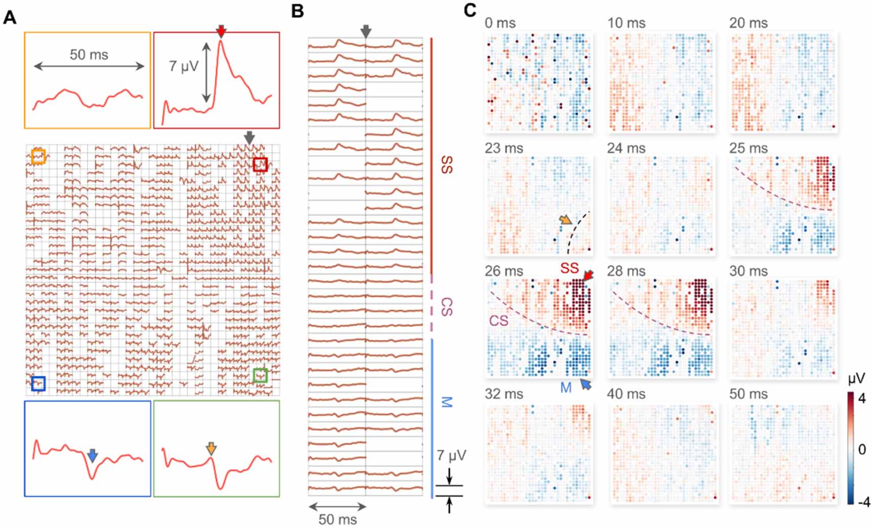 First-in-human experience performing high-resolution cortical mapping ...