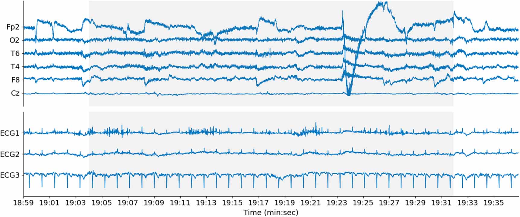 Epileptic seizure detection using heart rate variability from ...