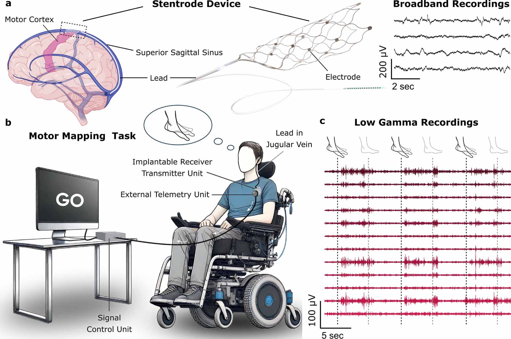 Motor activity in gamma and high gamma bands recorded with a Stentrode ...