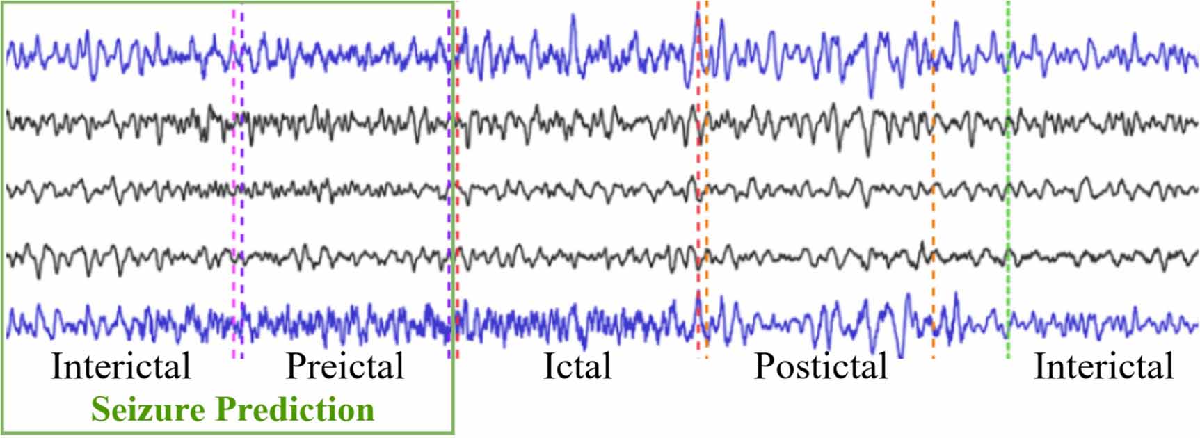FusionXNet: enhancing EEG-based seizure prediction with integrated ...