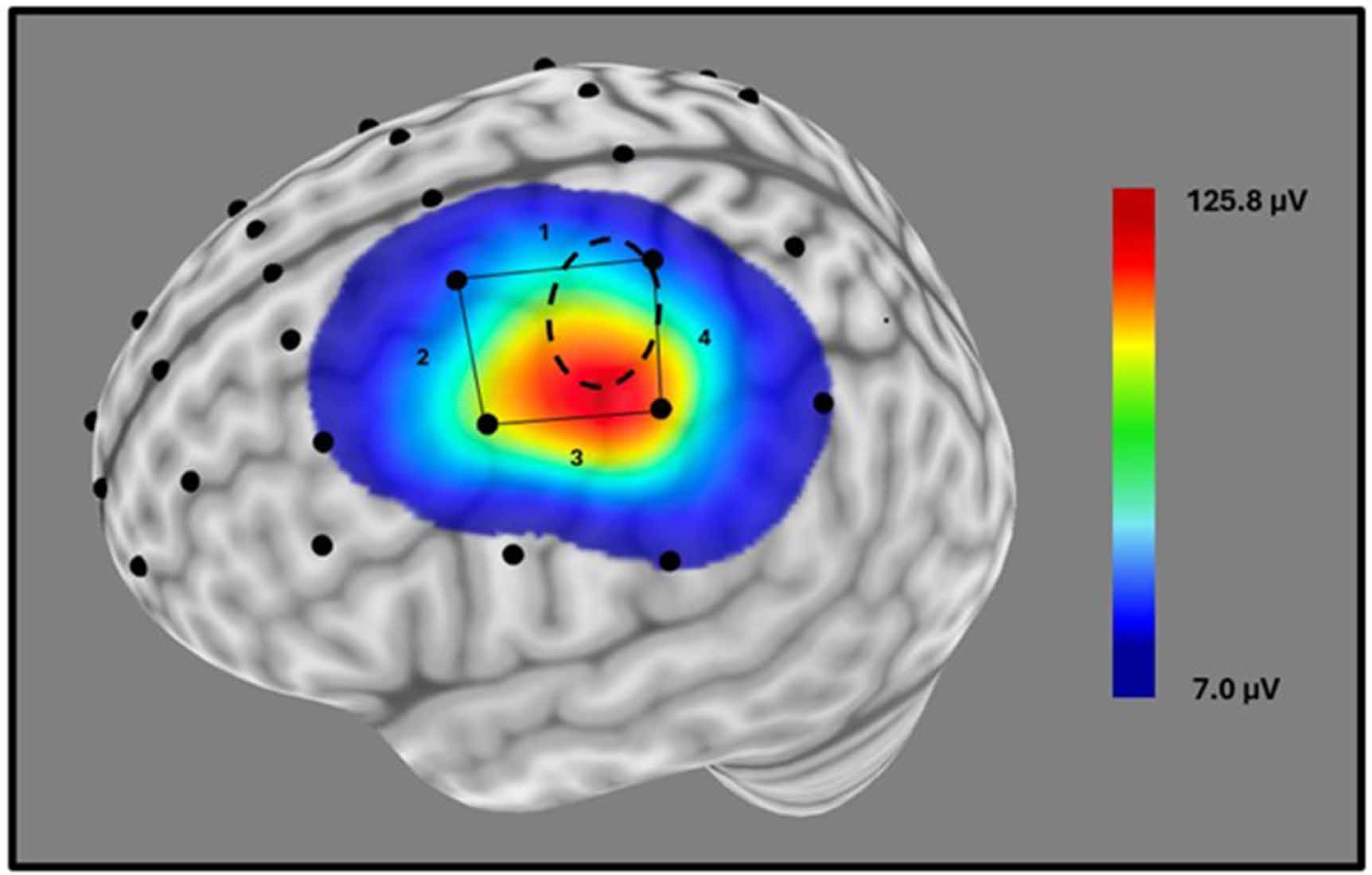 Refining signal localization: a transcranial magnetic stimulation motor ...