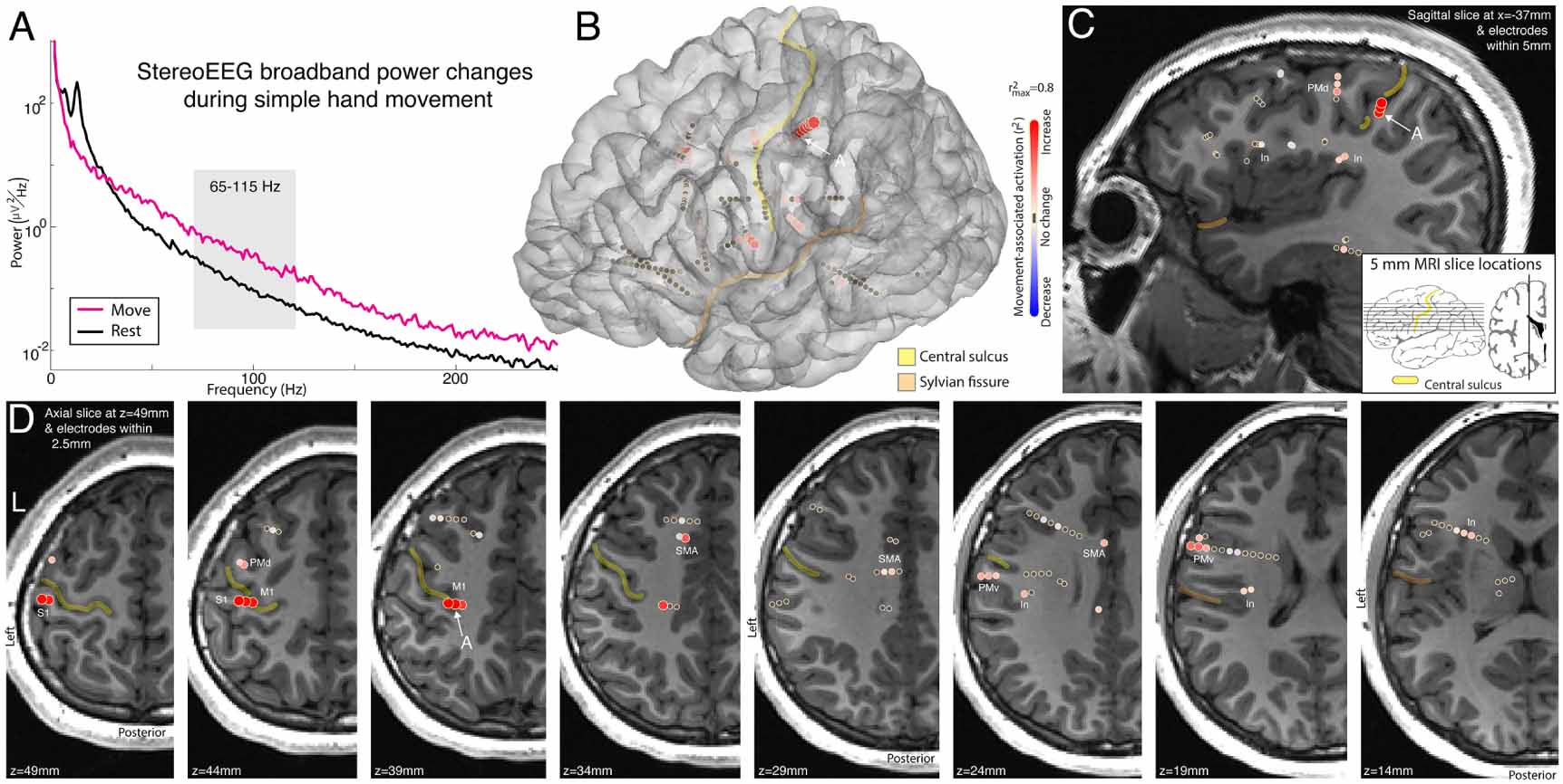 sEEG-based brain-computer interfacing in a large adult and pediatric ...