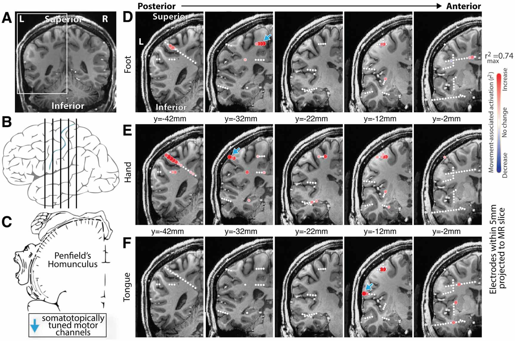 sEEG-based brain-computer interfacing in a large adult and pediatric ...