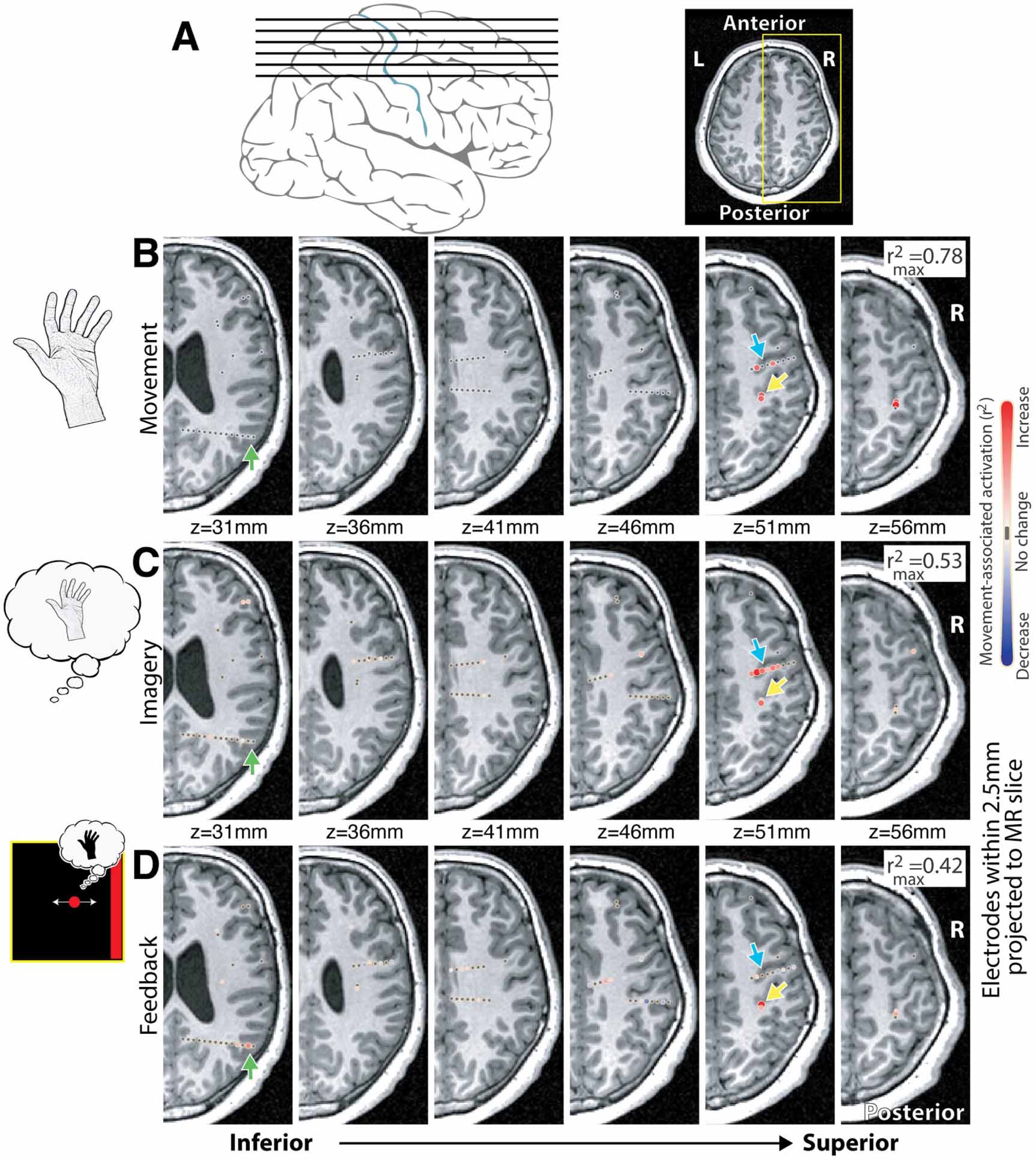 sEEG-based brain-computer interfacing in a large adult and pediatric ...