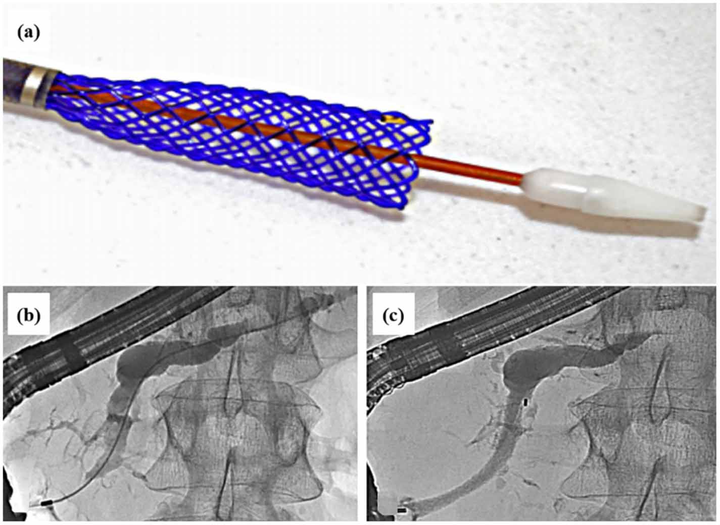A review on pancreatic duct stents: materials and emerging trends ...