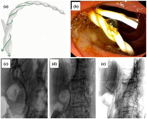 A review on pancreatic duct stents: materials and emerging trends ...