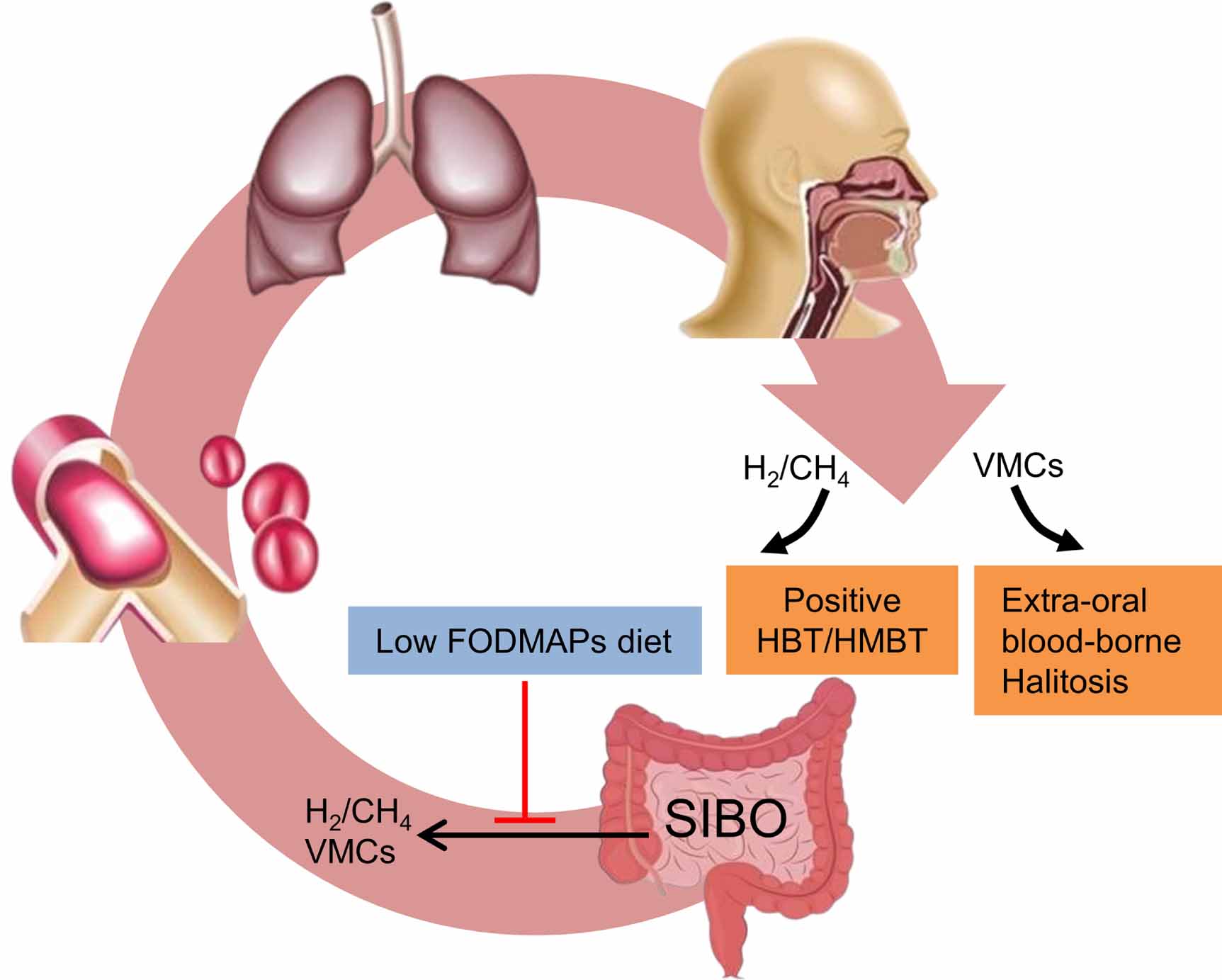 Therapeutic effect of the low FODMAPs diet for refractory halitosis ...