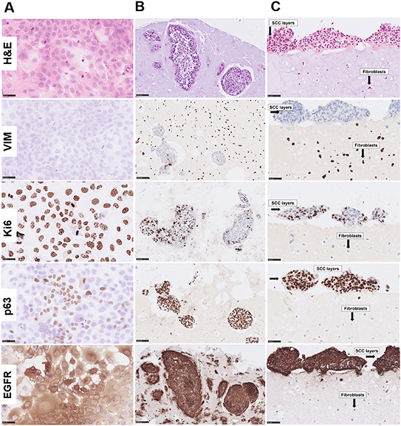 3D modeling of normal skin and cutaneous squamous cell carcinoma. A ...
