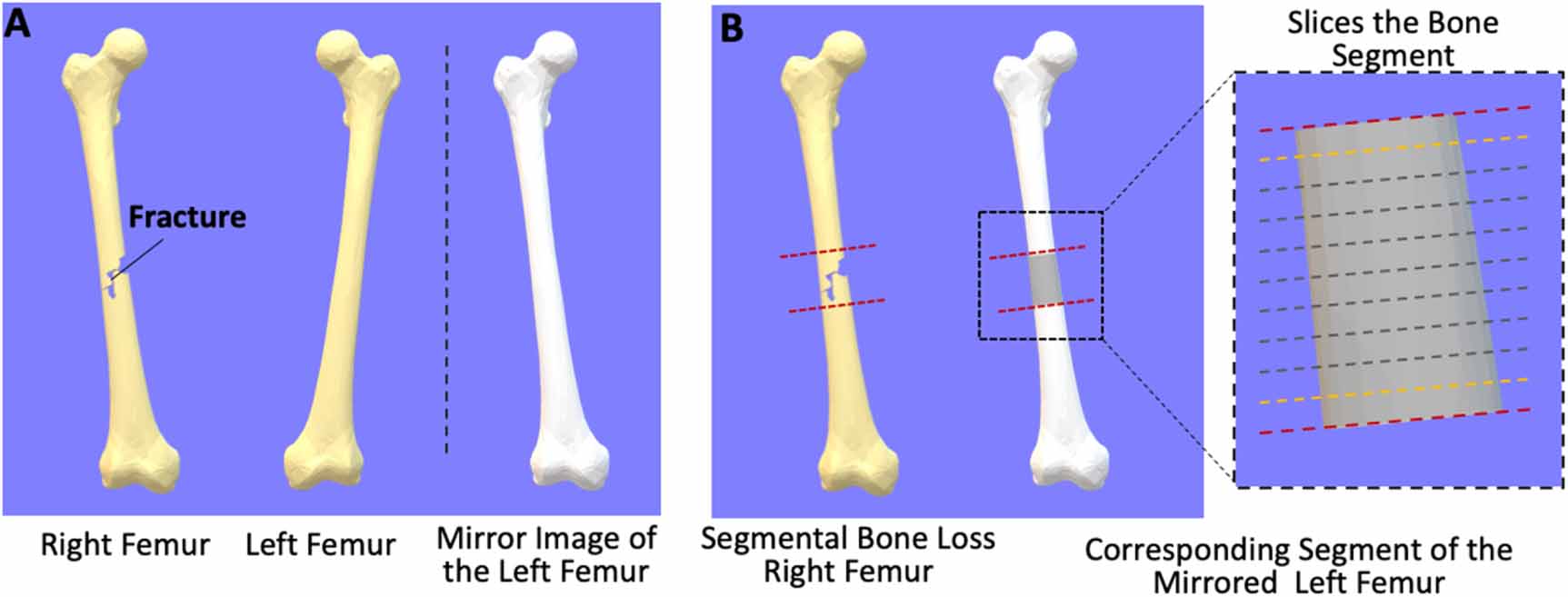 Fabricating vascularized, anatomically accurate bone grafts using 3D ...