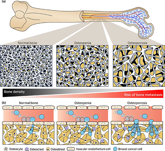 Bone-on-a-chip simulating bone metastasis in osteoporosis - IOPscience