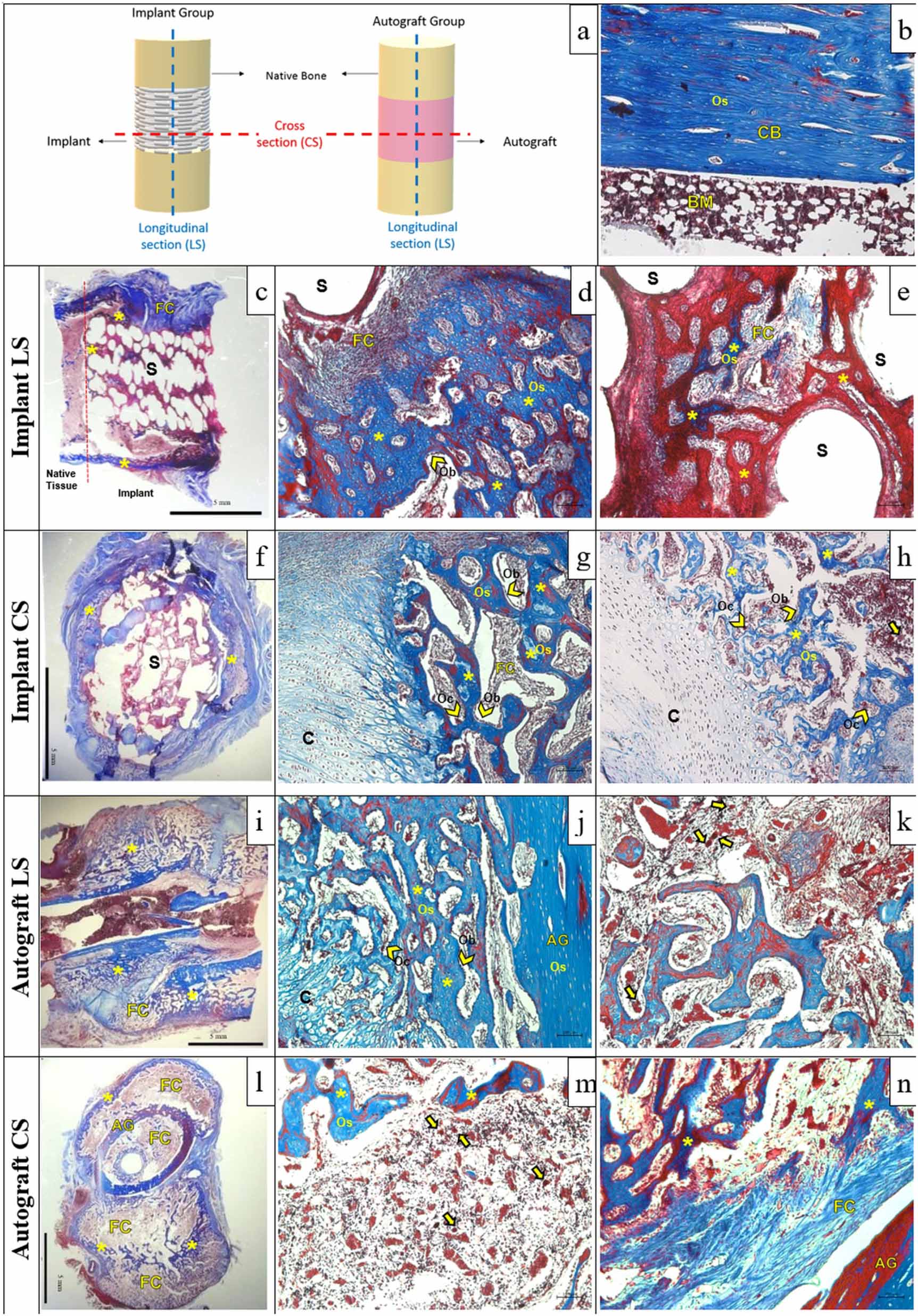 3D printed PCL-nHAp composite implants for the treatment of segmental ...