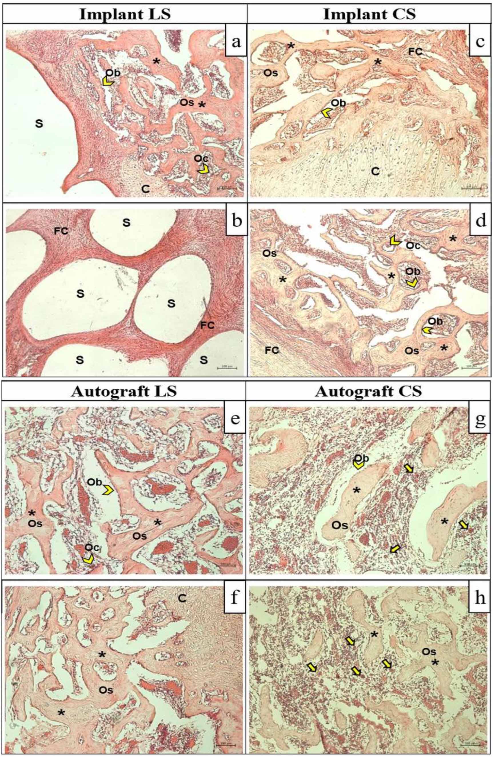 3D printed PCL-nHAp composite implants for the treatment of segmental ...