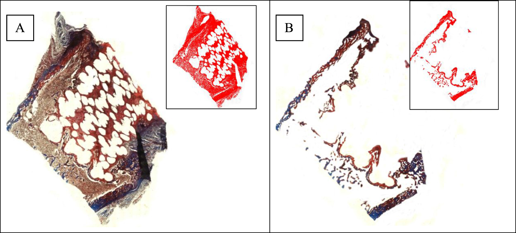 3D printed PCL-nHAp composite implants for the treatment of segmental ...