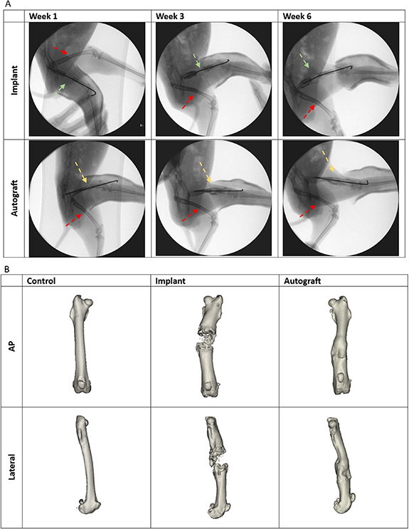 3D printed PCL-nHAp composite implants for the treatment of segmental ...