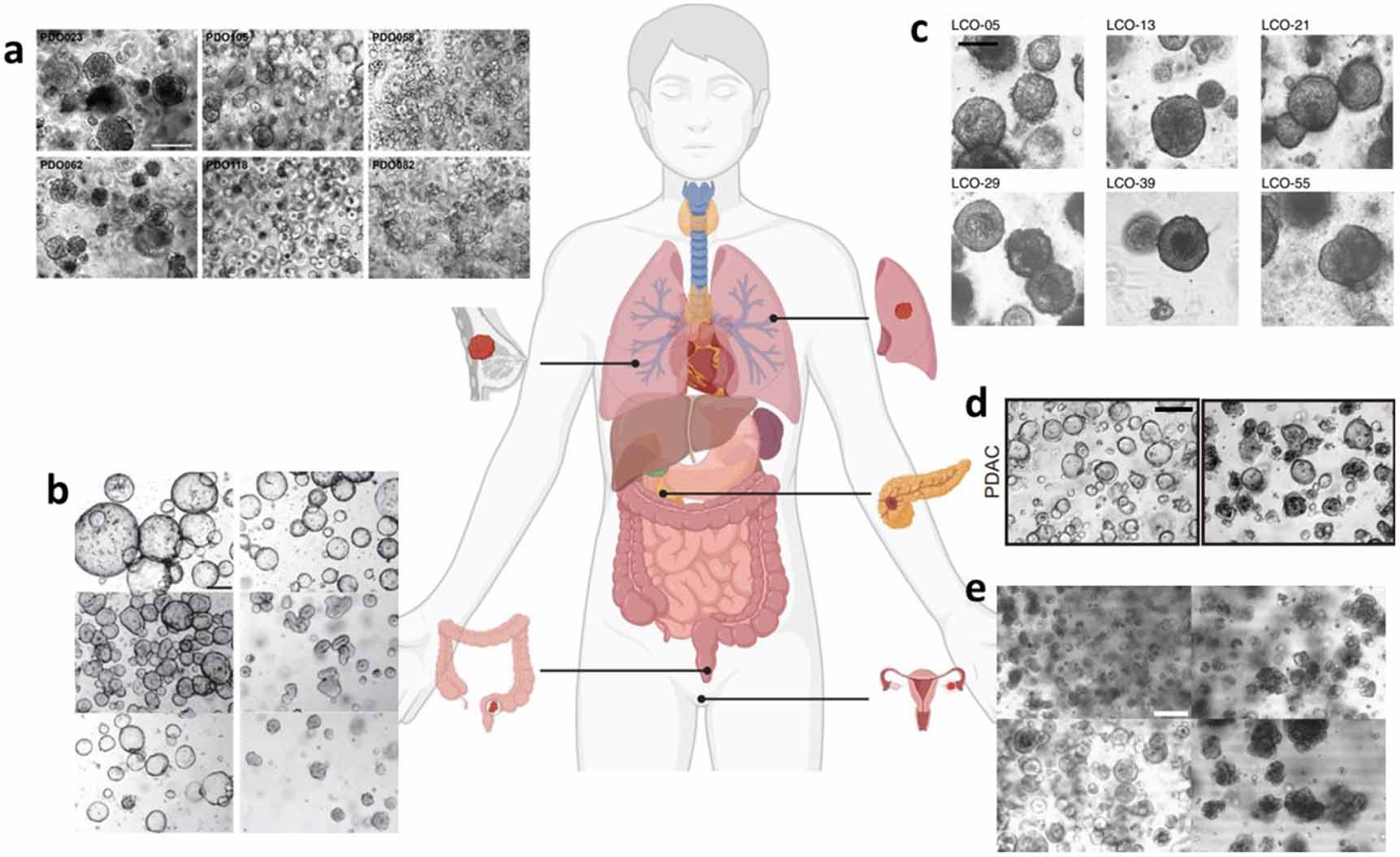 Tumor organoid and tumor-on-a-chip equipped next generation precision ...