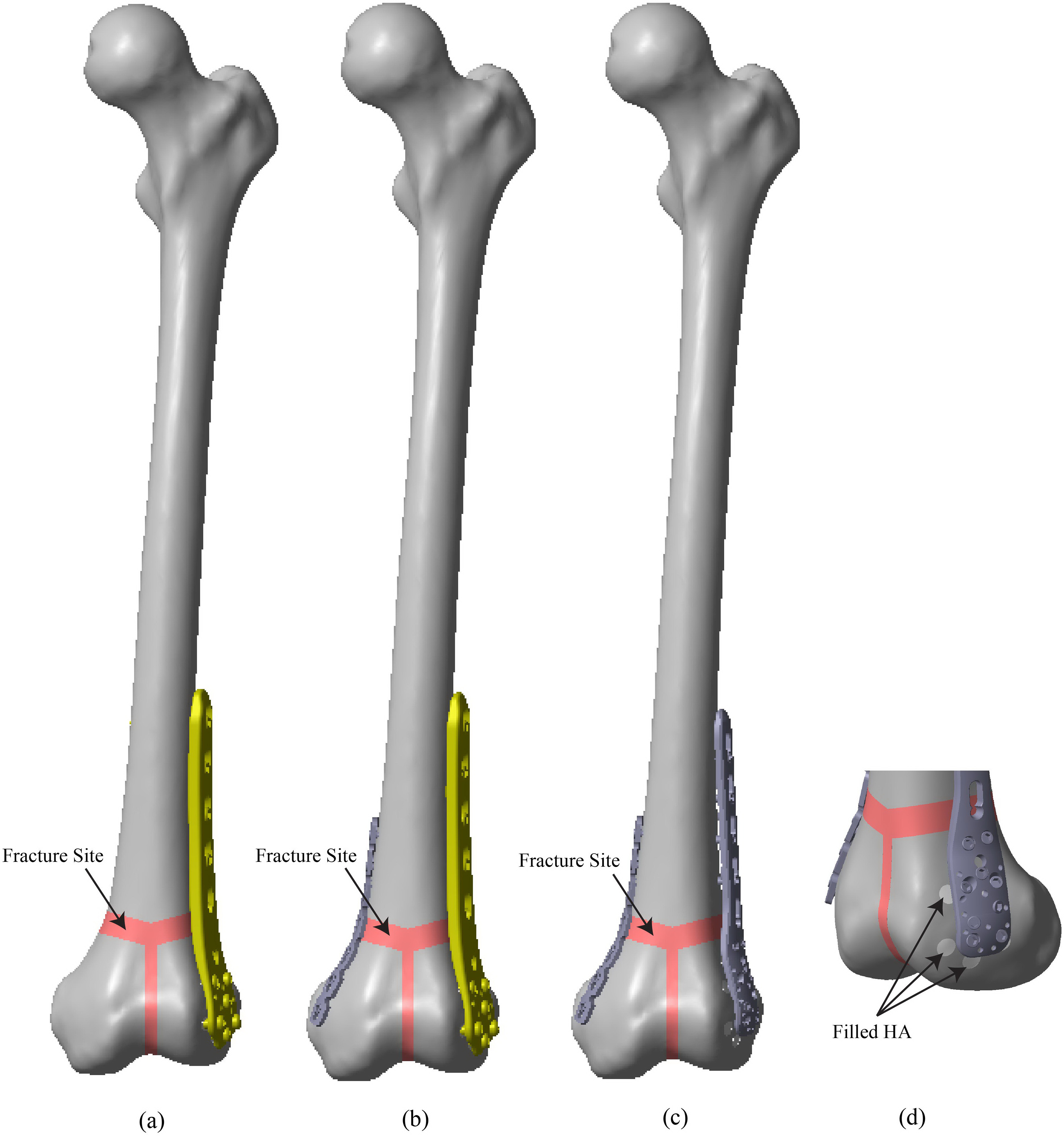 Dual plating for fixation failure of the distal femur: Finite element ...
