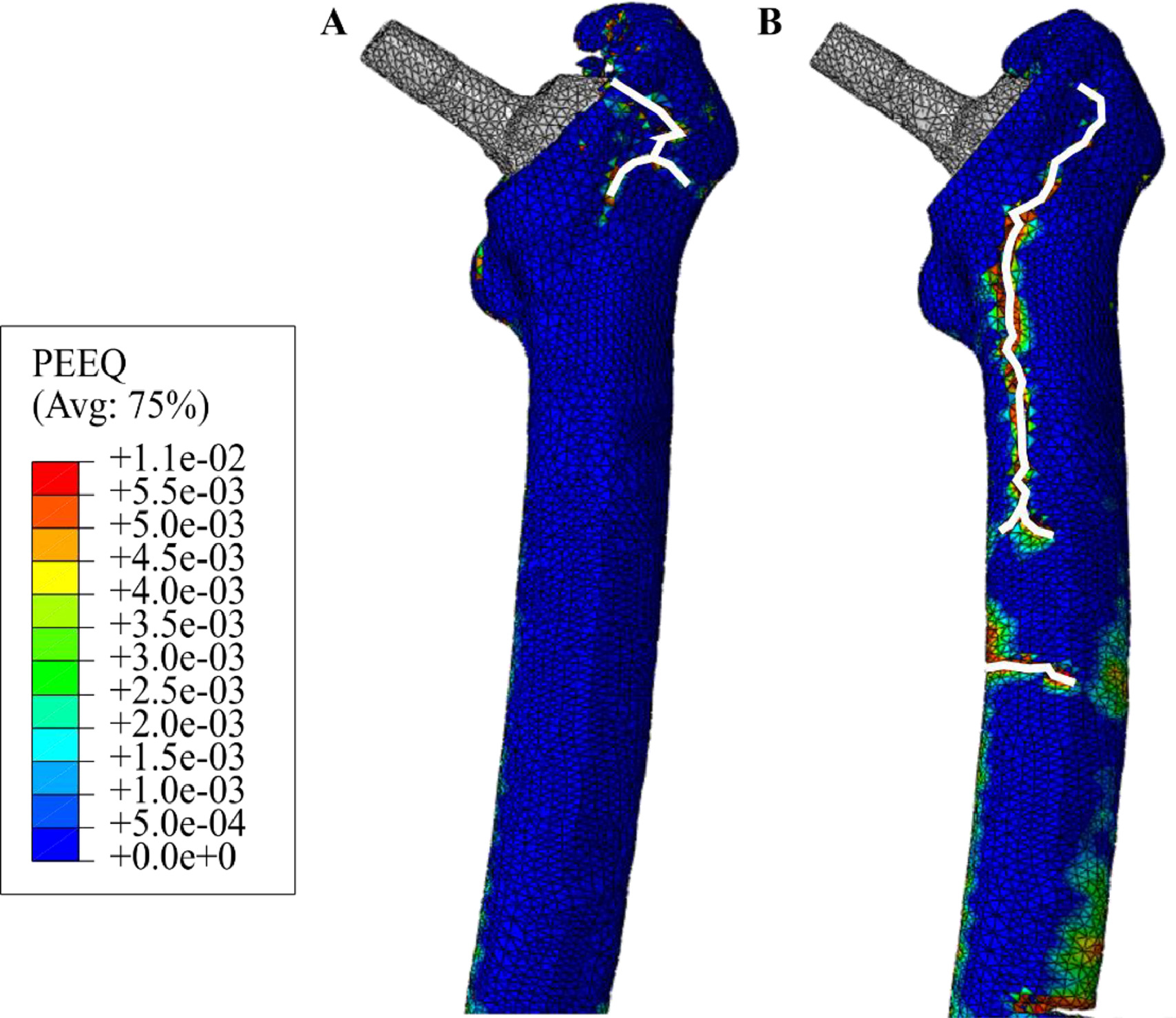 Influence of stem design parameters on periprosthetic femoral fractures ...