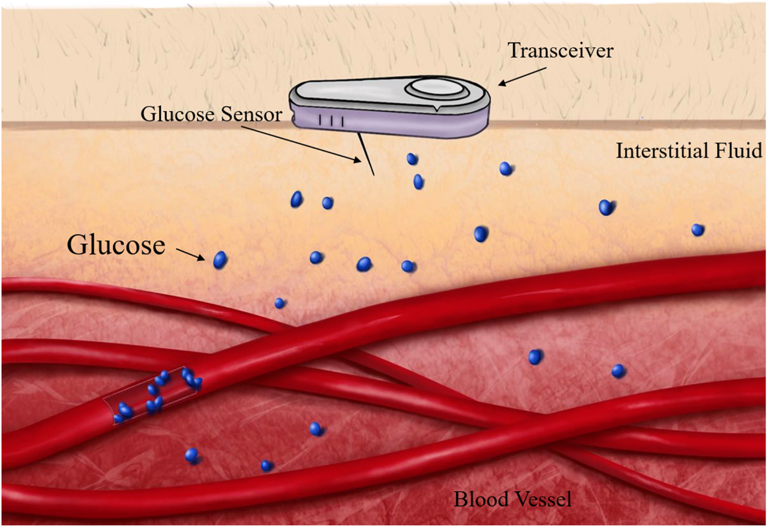 Review—Glucose Monitoring Sensors: History, Principle, and Challenges ...