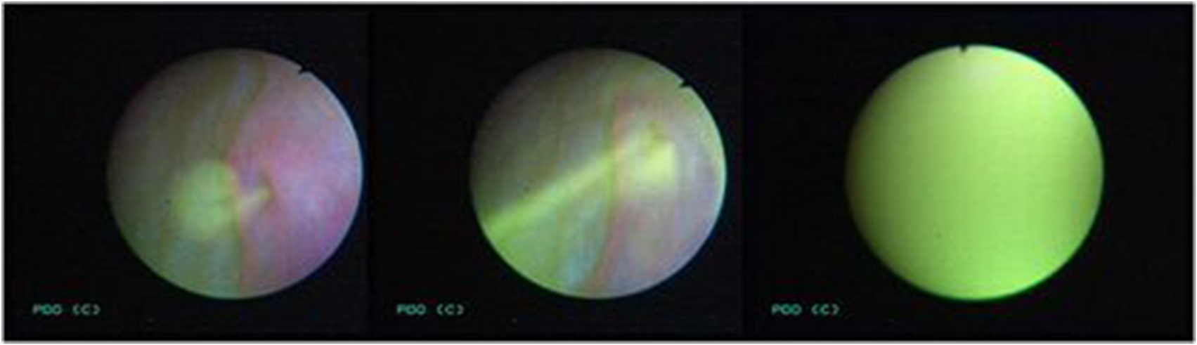 An optical method for reducing green fluorescence from urine during ...