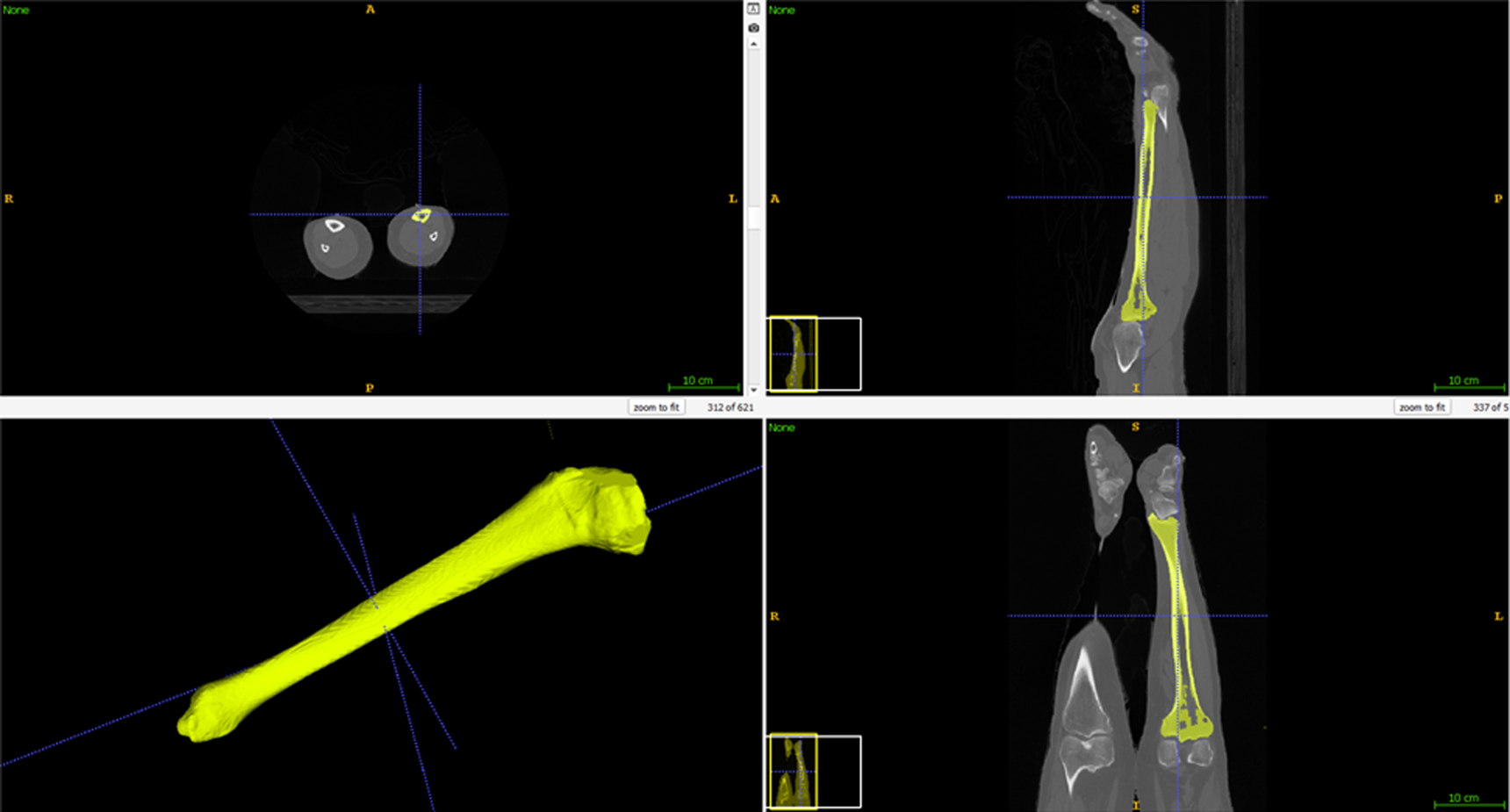 Effects of bone-plate materials on the healing process of fractured ...