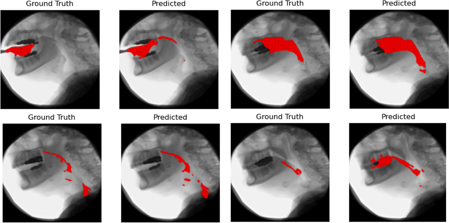 Use of deep learning to segment bolus during videofluoroscopic swallow ...