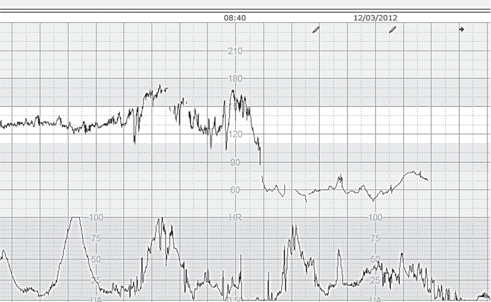 Fetal monitoring technologies for the detection of intrapartum hypoxia ...
