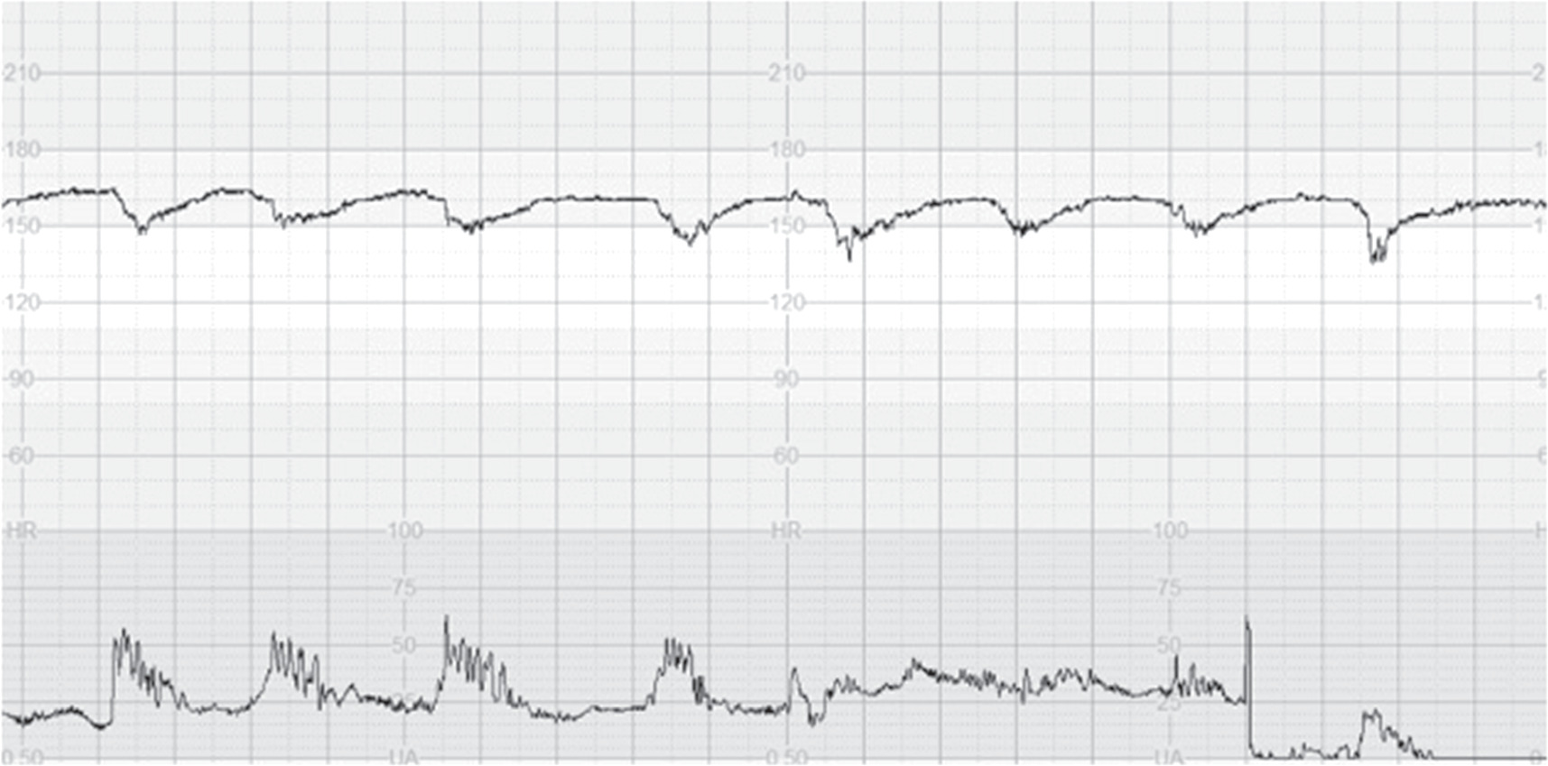Fetal monitoring technologies for the detection of intrapartum hypoxia ...