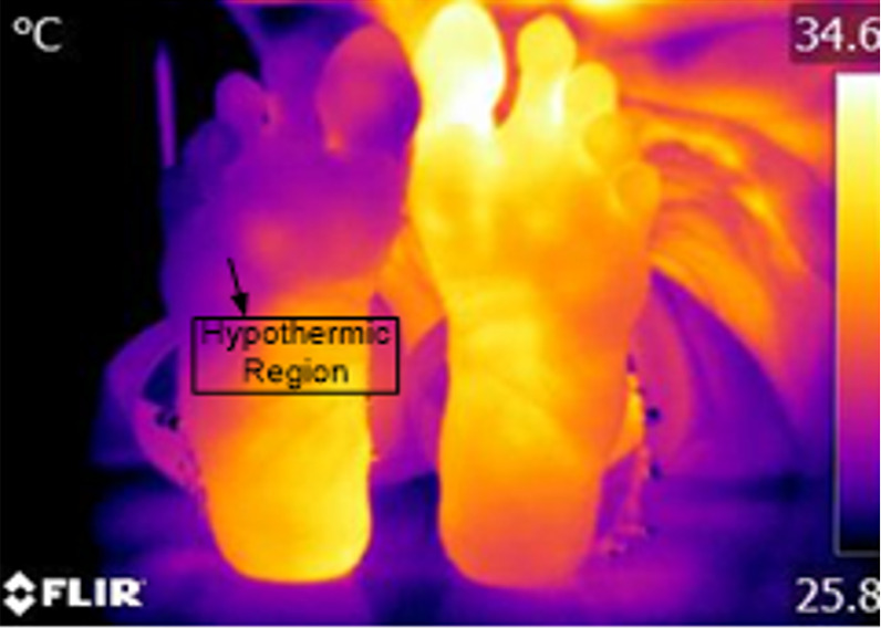 Automated prediction of diabetes mellitus using infrared thermal foot ...