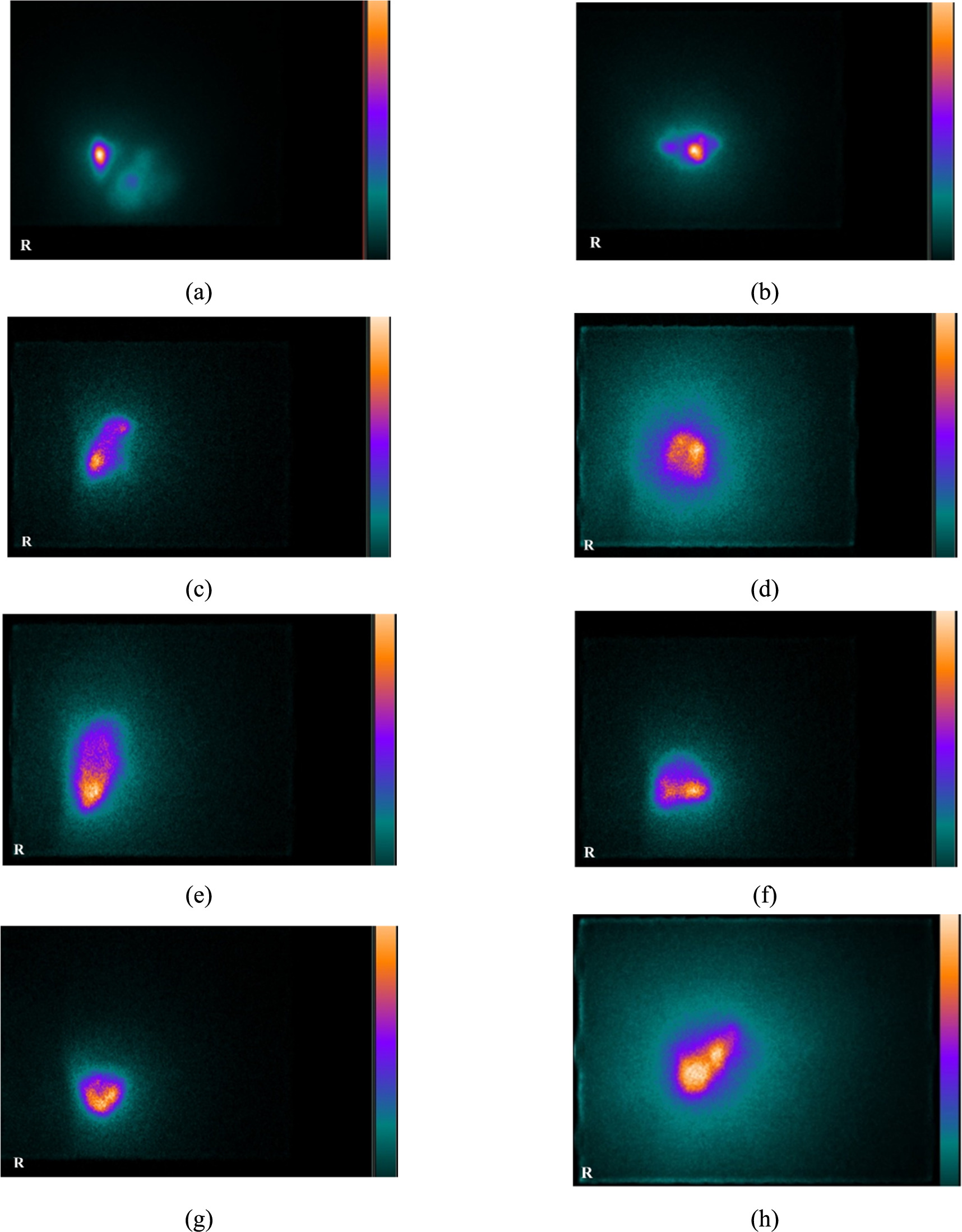 Energy window optimization in bremsstrahlung imaging after Yttrium-90 ...