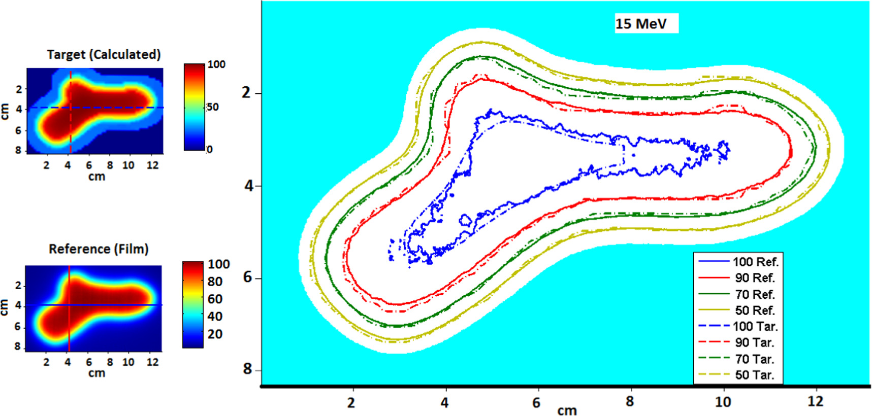 Planar dose calculation of electron therapy - IOPscience