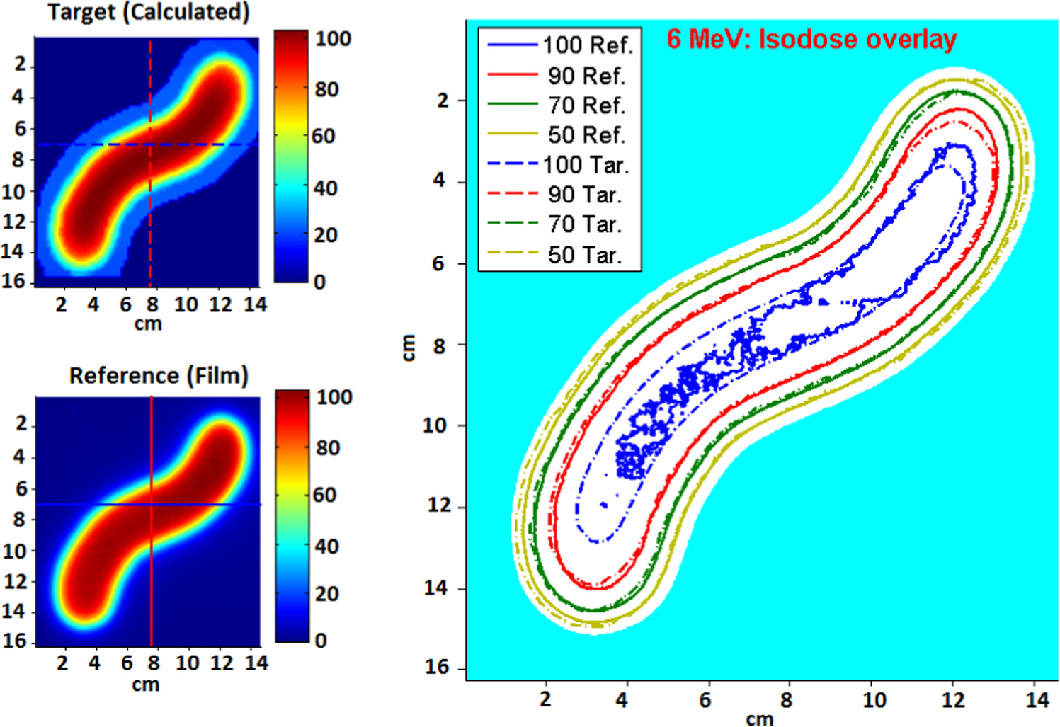 Planar dose calculation of electron therapy - IOPscience