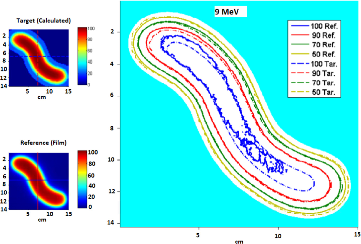 Planar dose calculation of electron therapy - IOPscience