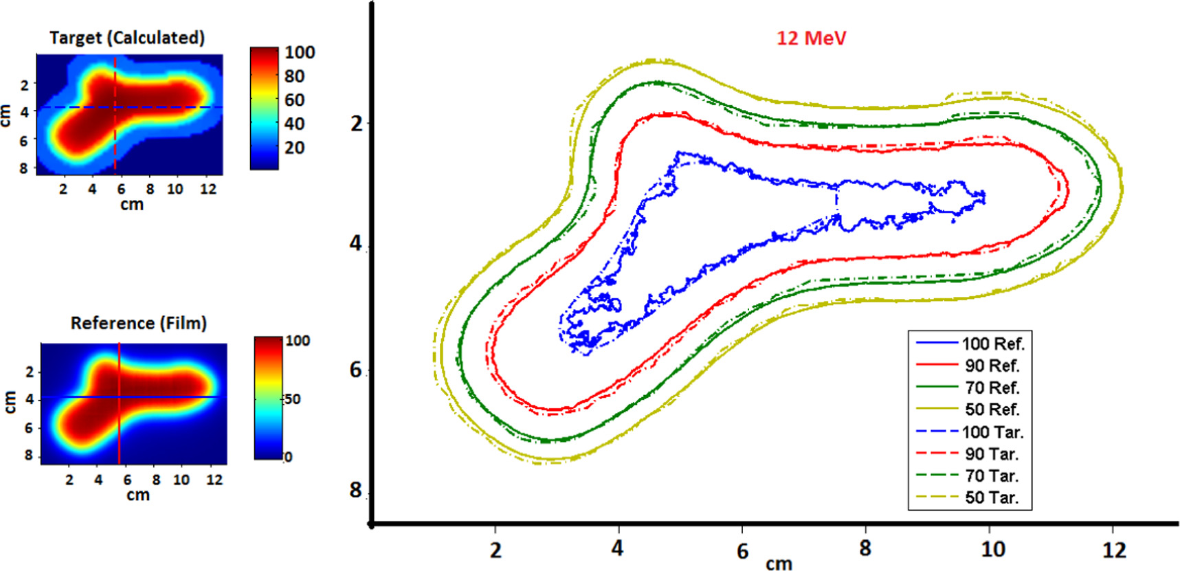 Planar dose calculation of electron therapy - IOPscience