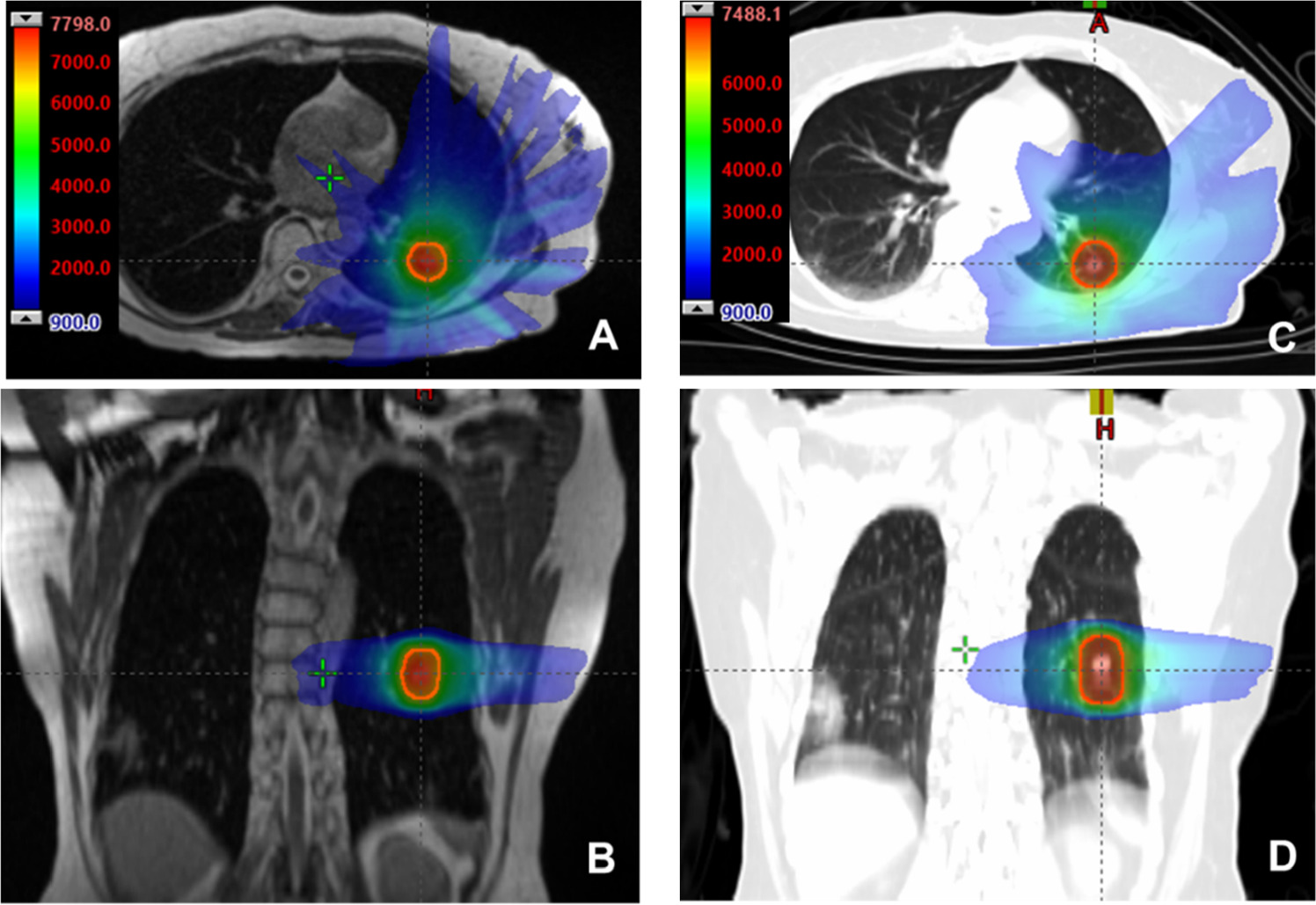 Lung sparing in MR-guided non-adaptive SBRT treatment of peripheral ...