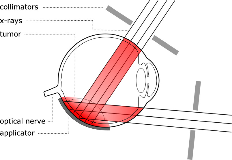 Measurements regarding a combined therapy concept for ophthalmic tumors ...