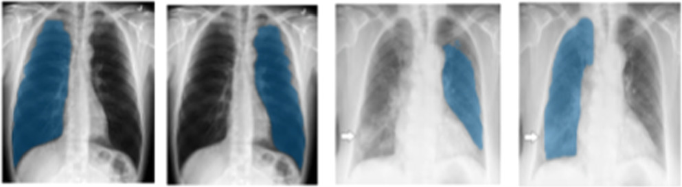 Lung segment anything model (LuSAM): a decoupled prompt-integrated ...