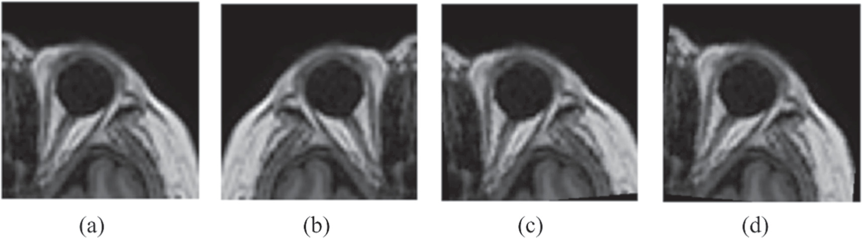 Classification of optic neuritis in neuromyelitis optica spectrum ...