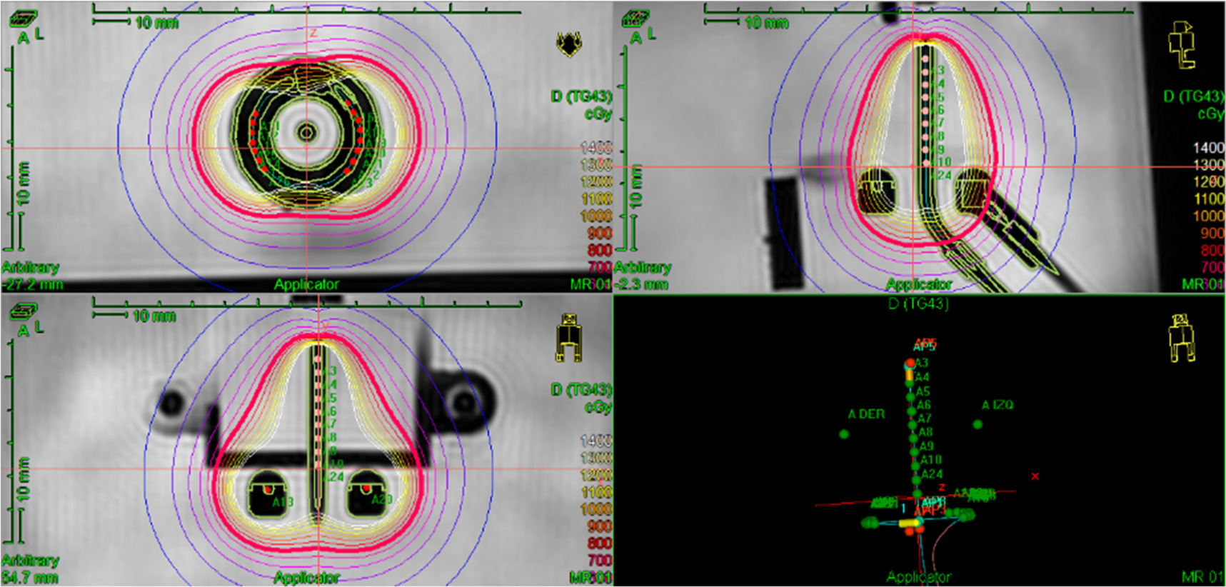 Commissioning of MRI-guided gynaecological brachytherapy using an MR ...
